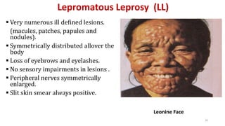 Leprosy | PPT