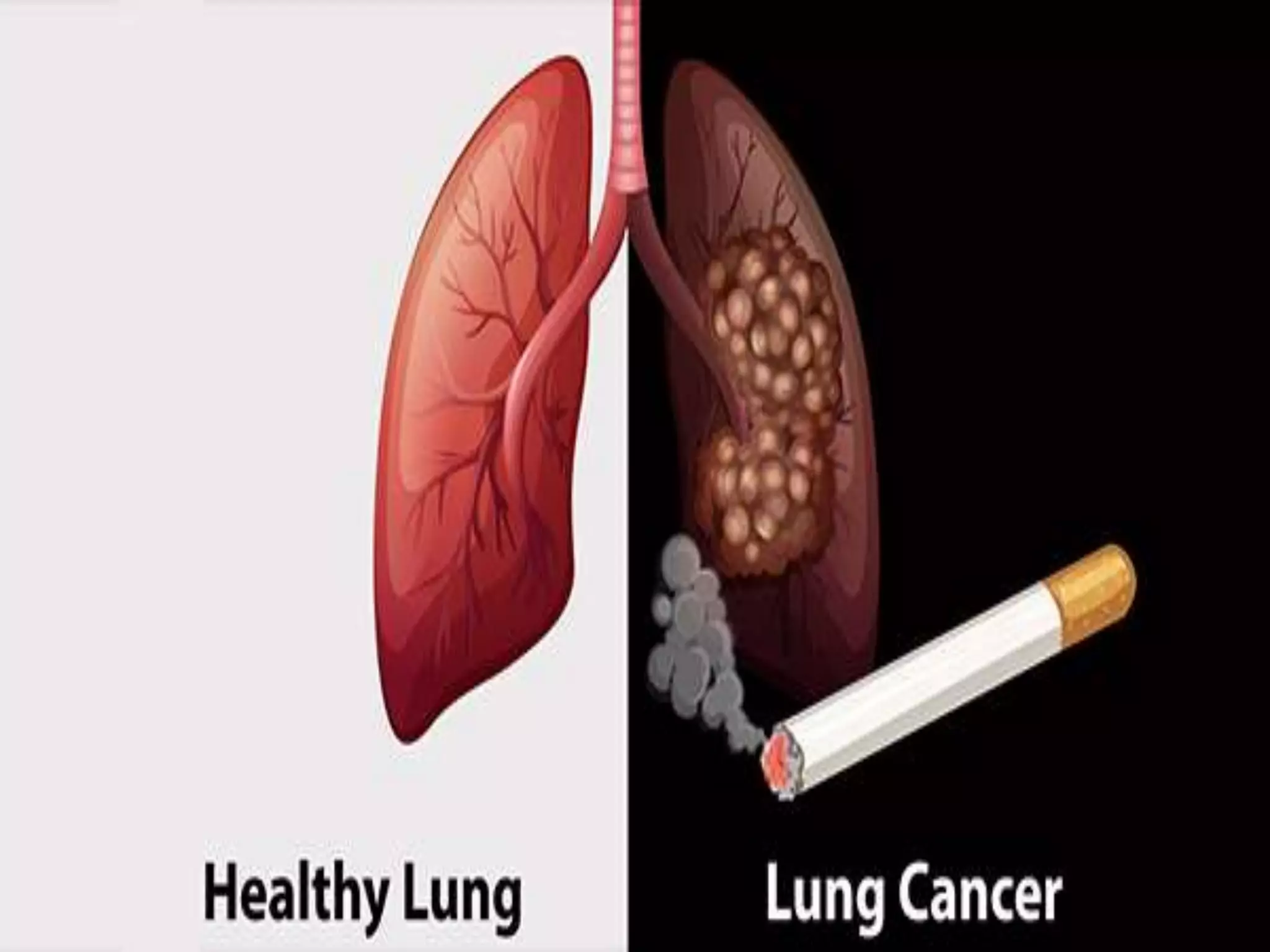 Presentation lung | PPT