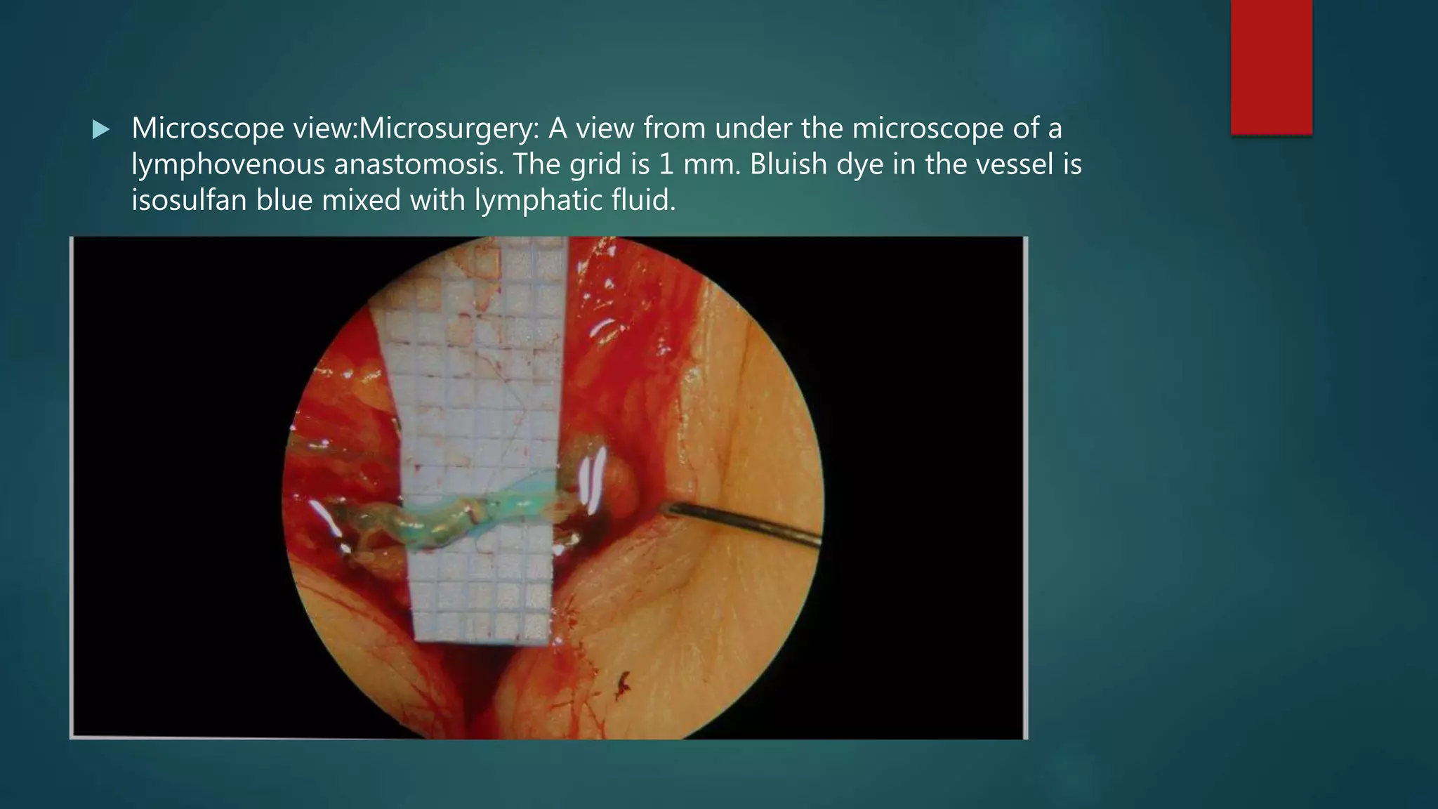 Presentation microsurgery | PPTX