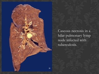 Caseous Necrosis Gross