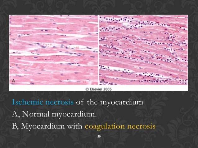 Heart Muscle Necrosis | Necrosis: What Is, Types, Symptoms, Risk ...