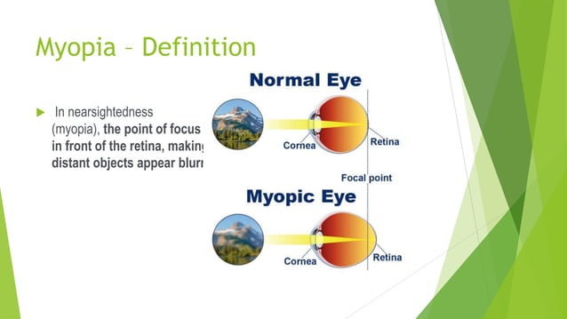 Myopia.pptx