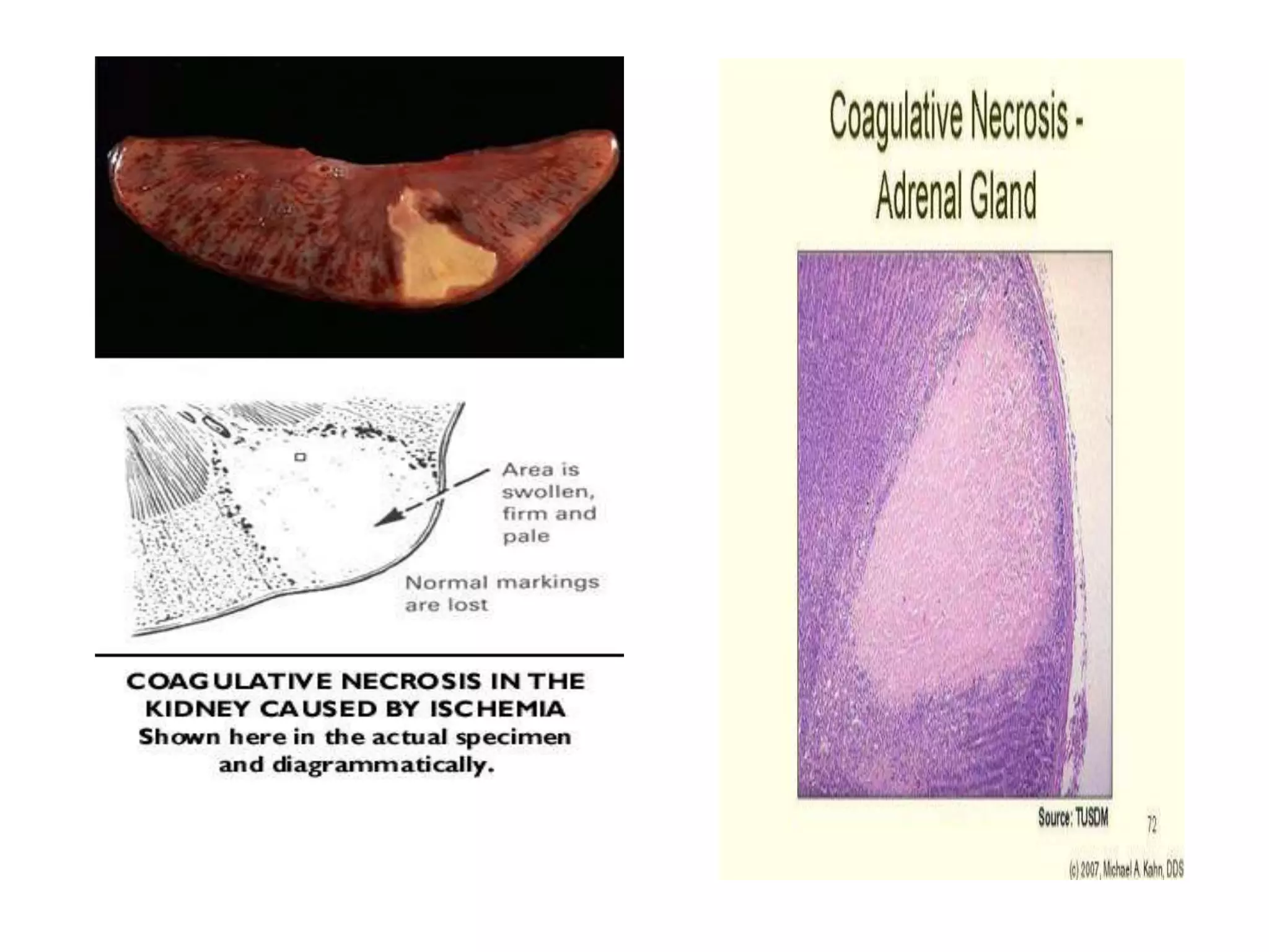 Presentation necrosis | PPT