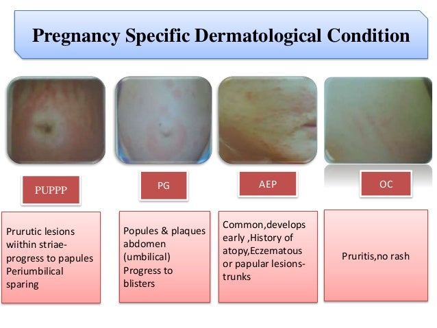 Pruritus in pregnancy