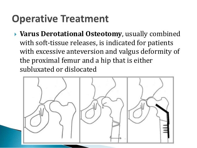 Presentation of cerebral palsy
