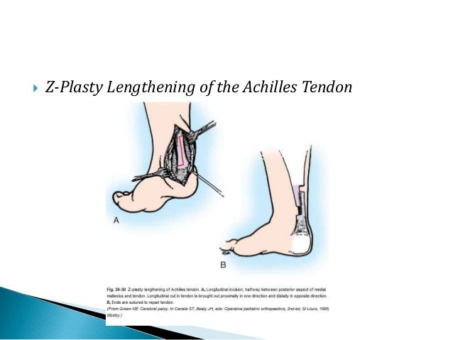 Presentation of cerebral palsy