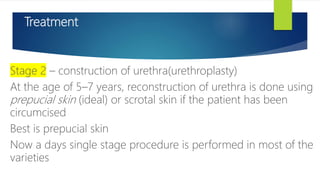 Presentation of Hypospadias for MBBS | PPTX