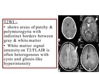Rasmussen encephalitis in the eye of a Radiologist | PPTX