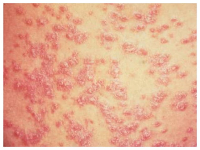 presentationofstreptococcus-180731145601.pdf