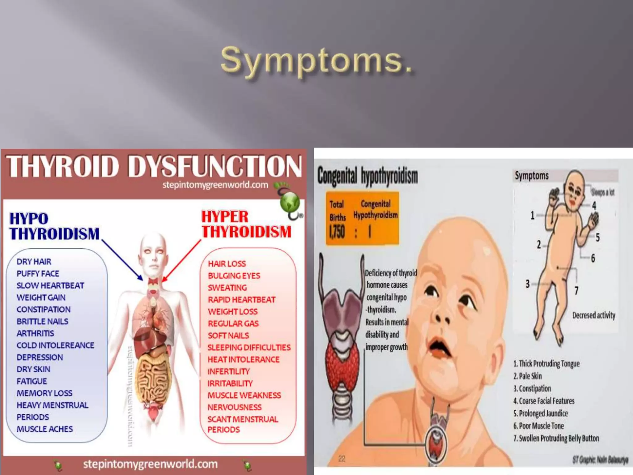 Congenital Hypothyroidism | PPTX
