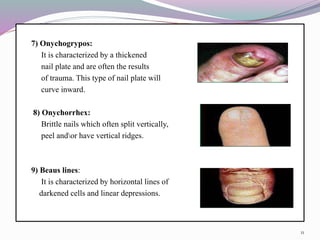 Presentation of transungual | PPTX | Nail Care | Beauty