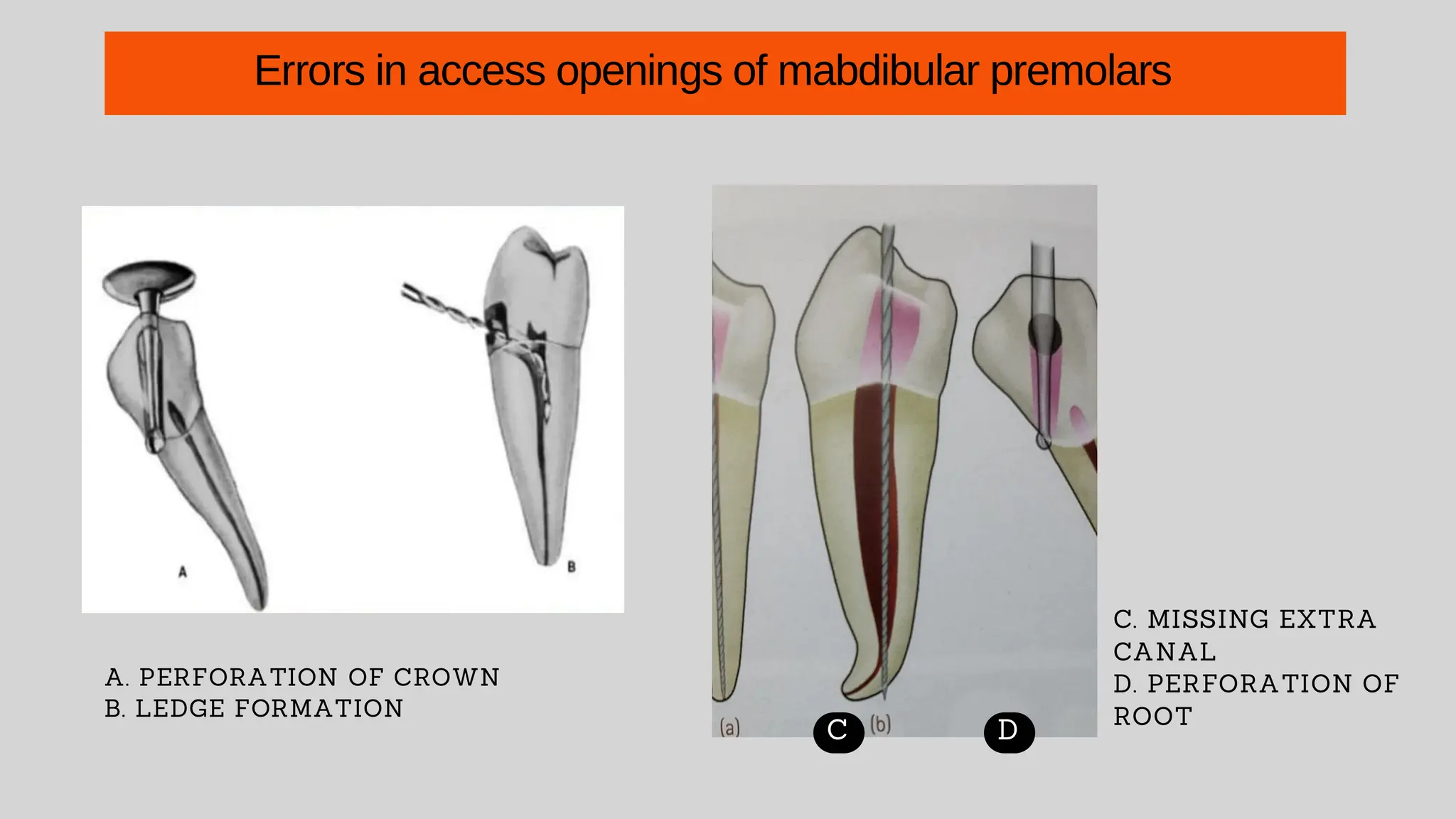 Presentation on Access Cavity Preparation in Premolars (Maxillary and Mandibular).pdf