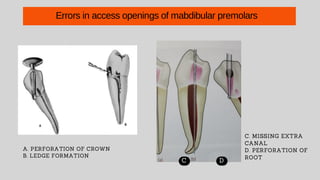 Presentation on Access Cavity Preparation in Premolars (Maxillary and ...