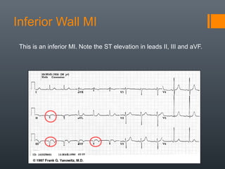 Presentation on anatomy of heart ,coronary circulation ,mi and ecg ...