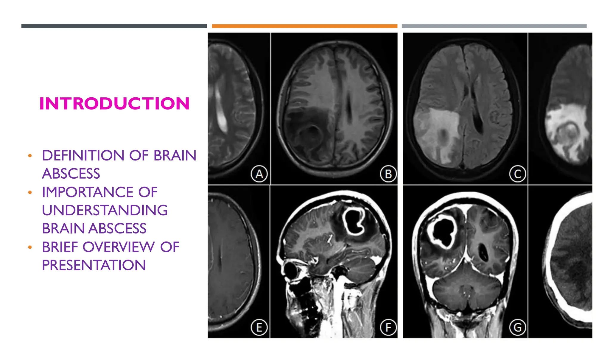 PRESENTATION ON BRAIN ABCESS AND ITS SUMMARIZATION | PDF