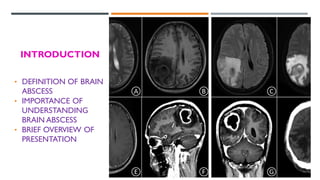 PRESENTATION ON BRAIN ABCESS AND ITS SUMMARIZATION | PDF
