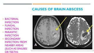 PRESENTATION ON BRAIN ABCESS AND ITS SUMMARIZATION | PDF