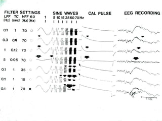 EEG calibration and its steps | PPTX