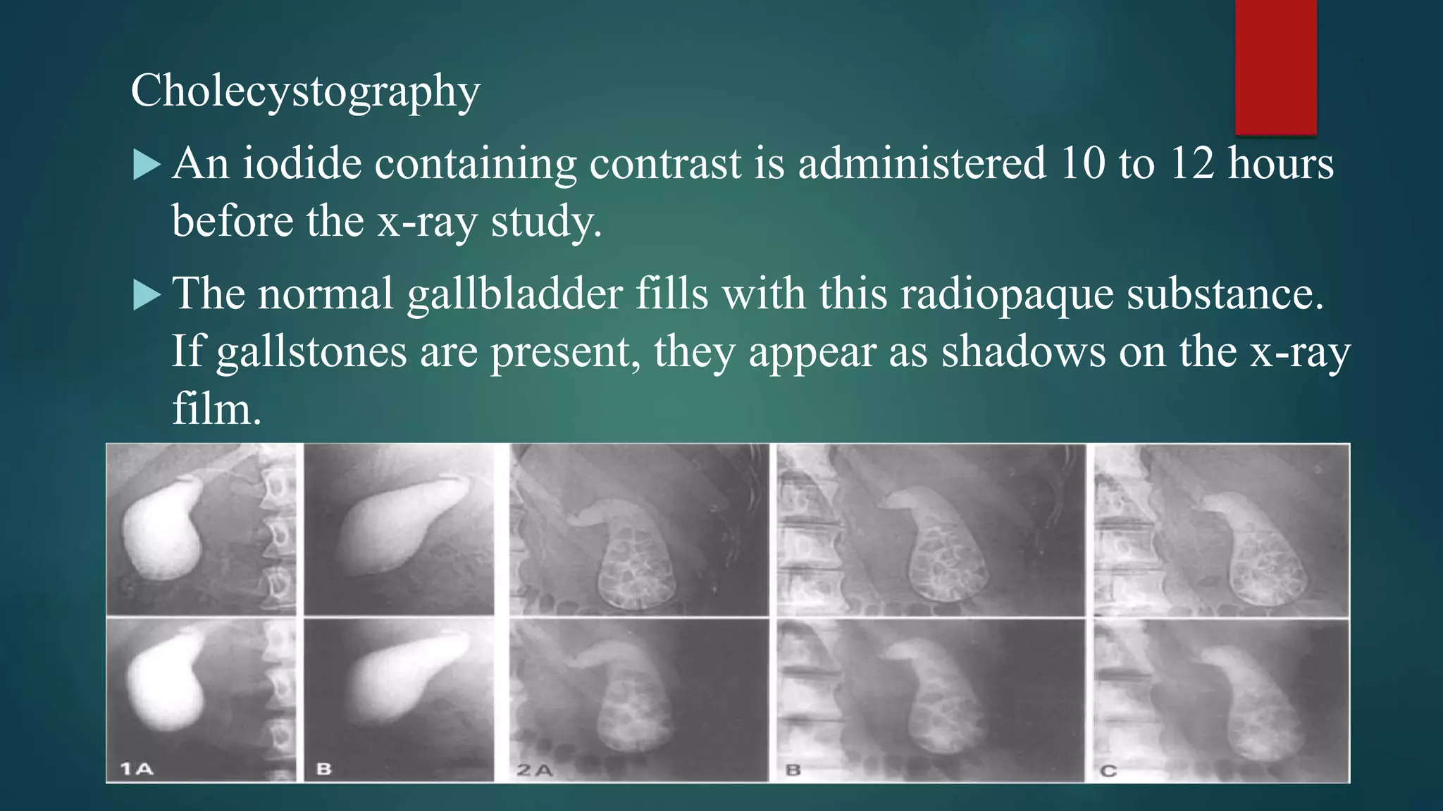 Presentation on cholelithiasis | PPTX