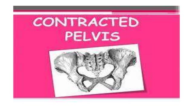 Presentation on contracted pelvis | PPT