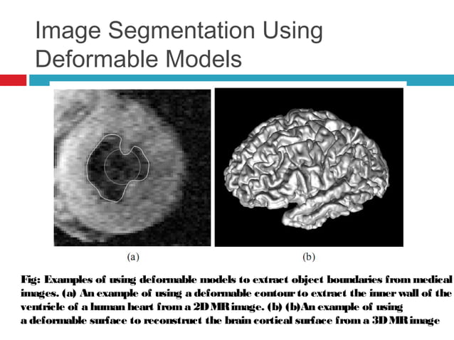 Presentation On Deformable Model For Medical Image Segmentation Ppt
