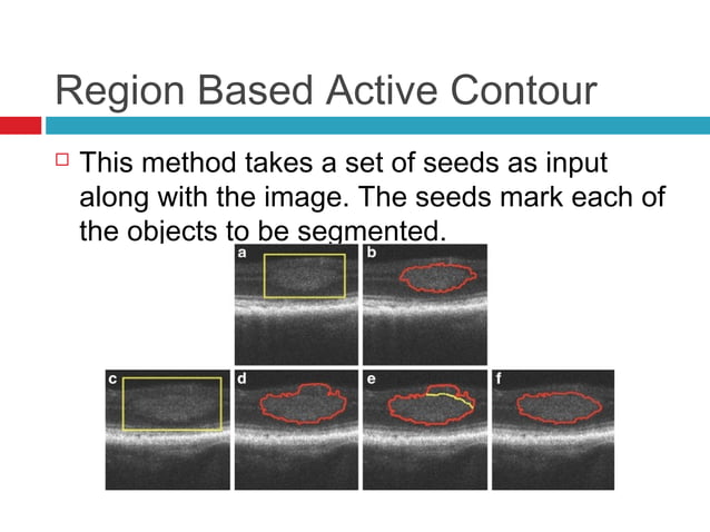 Presentation On Deformable Model For Medical Image Segmentation Ppt