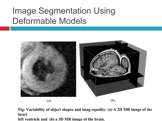Presentation On Deformable Model For Medical Image Segmentation Ppt
