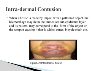 Presentation on examination of bruise.pptx