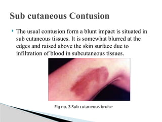 Presentation on examination of bruise.pptx