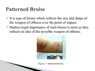 Presentation on examination of bruise.pptx