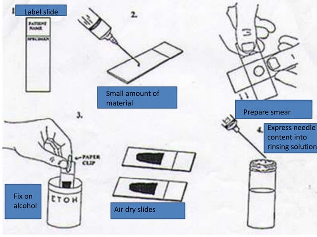 Fine Needle Aspiration cytology(FNAC)