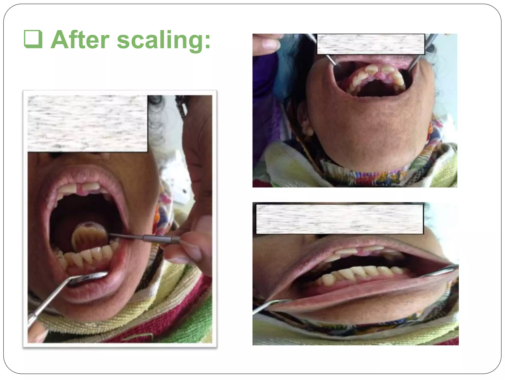 Case presentation on EPULIS | PPTX