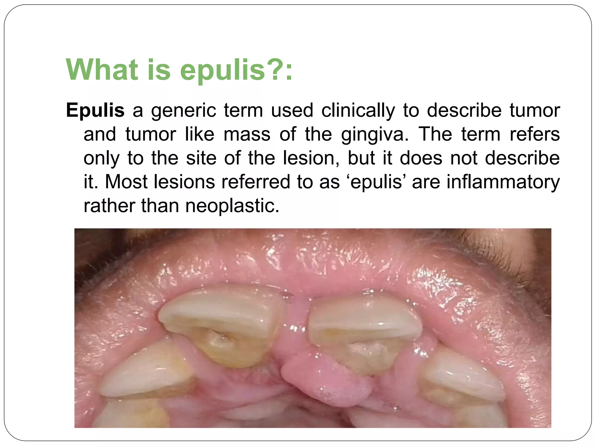 Case presentation on EPULIS | PPTX