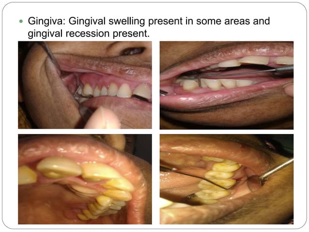 Case presentation on EPULIS | PPTX | Dental Health | Diseases and ...