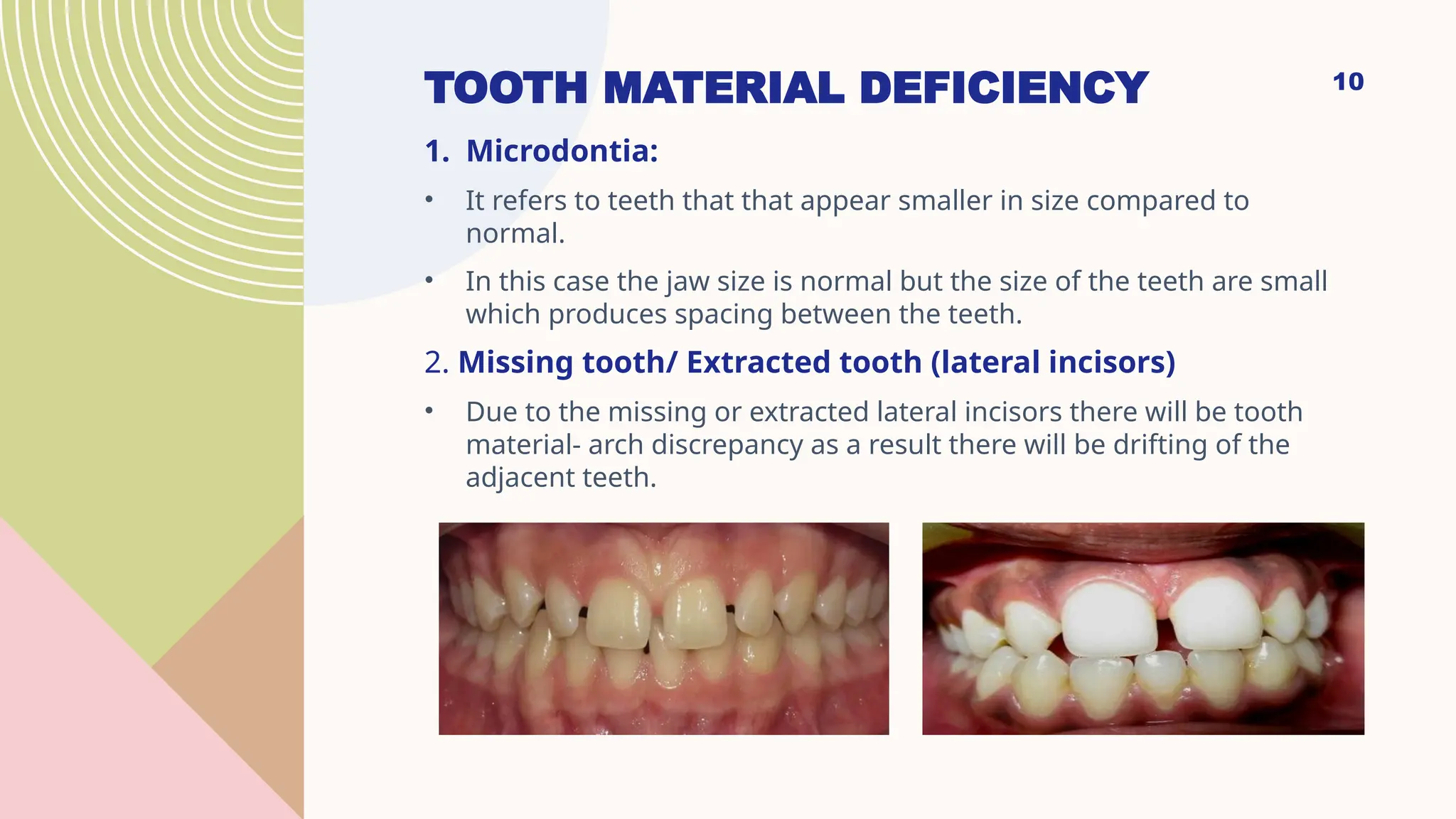 Presentation on Midline Diastema correction.pptx