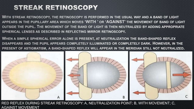 Presentation on Neutralization steps of retinoscopy.pptx