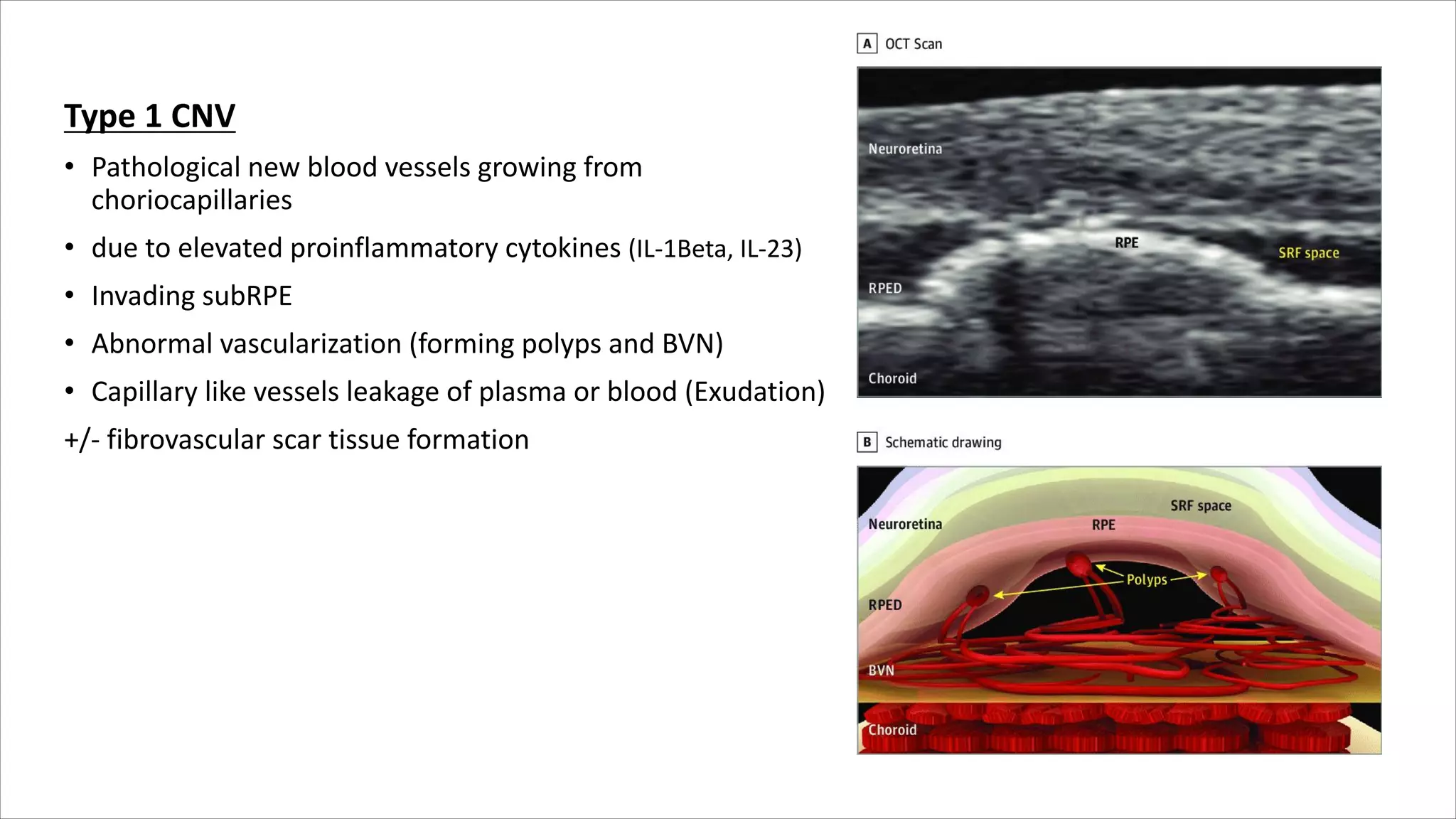 Presentation on Polypoidal Choroidal Vasculopathy.pdf