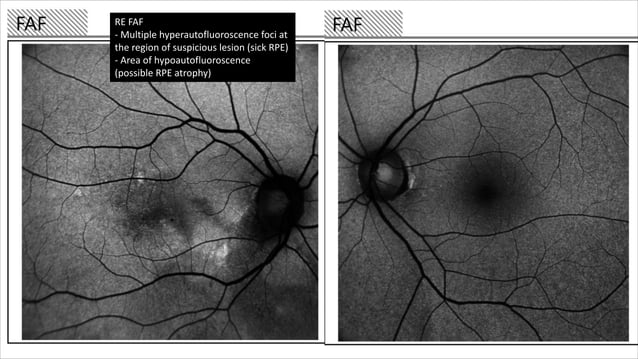 Presentation on Polypoidal Choroidal Vasculopathy.pdf | Eye and Vision ...