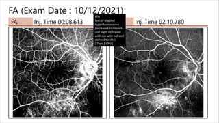 Presentation on Polypoidal Choroidal Vasculopathy.pdf