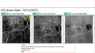Presentation on Polypoidal Choroidal Vasculopathy.pdf