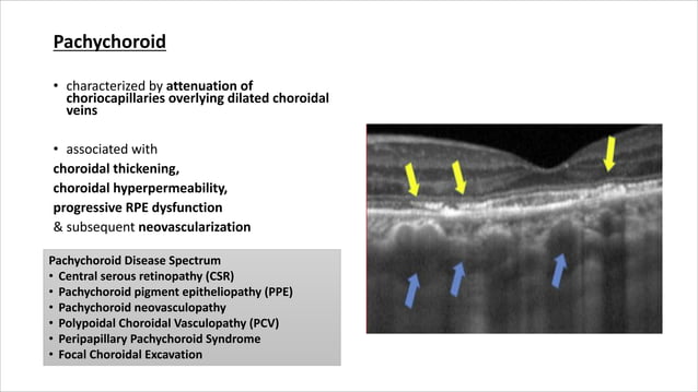 Presentation on Polypoidal Choroidal Vasculopathy.pdf | Eye and Vision ...