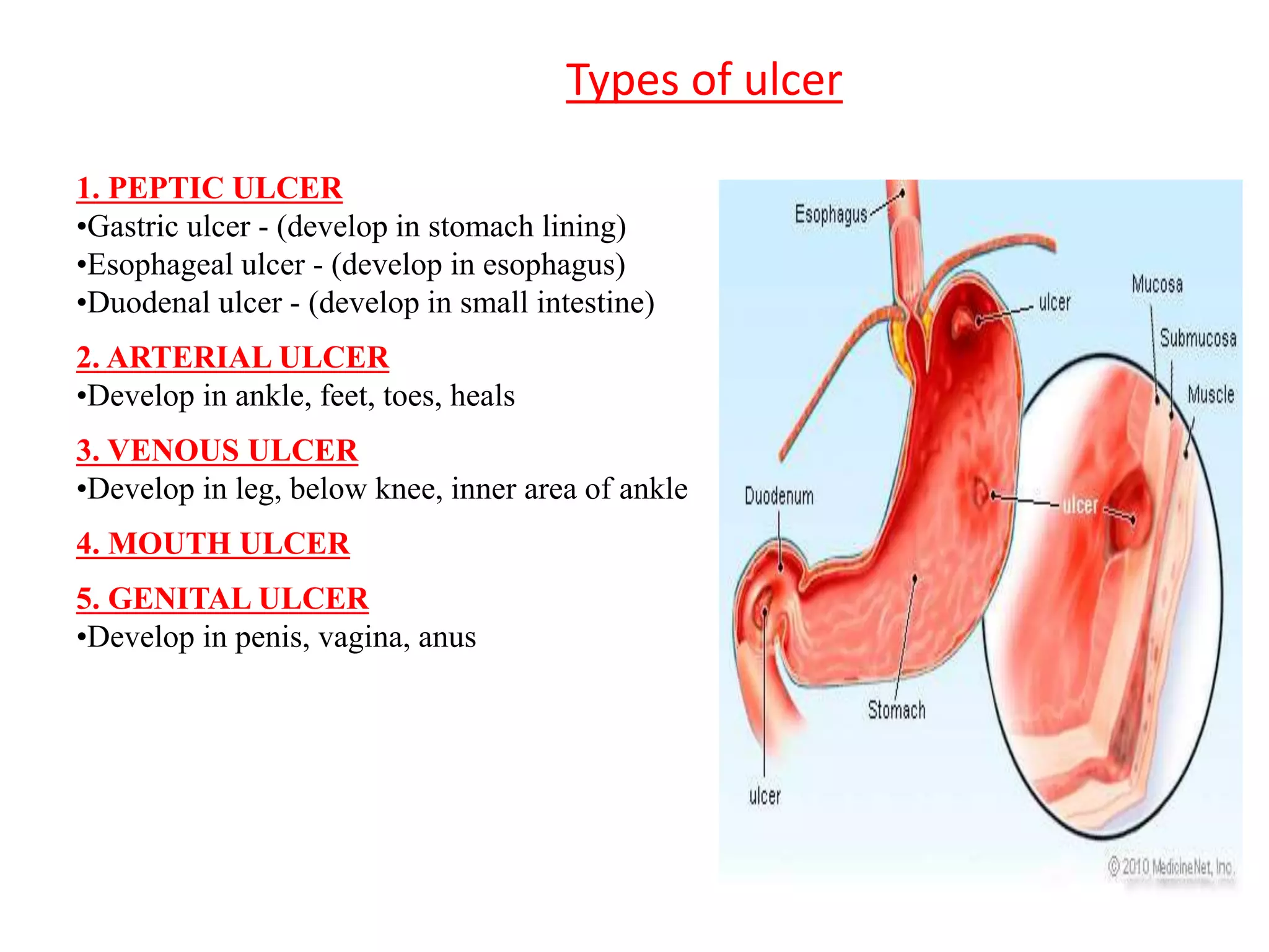 Presentation on peptic ulcer | PPTX