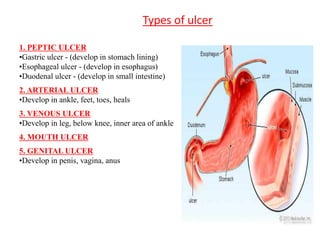 Presentation on peptic ulcer | PPTX | Digestive Disorders | Diseases ...