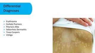 Presentation on Pityriasis Versicolor .pptx