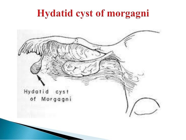 Reproductive tract anomalies