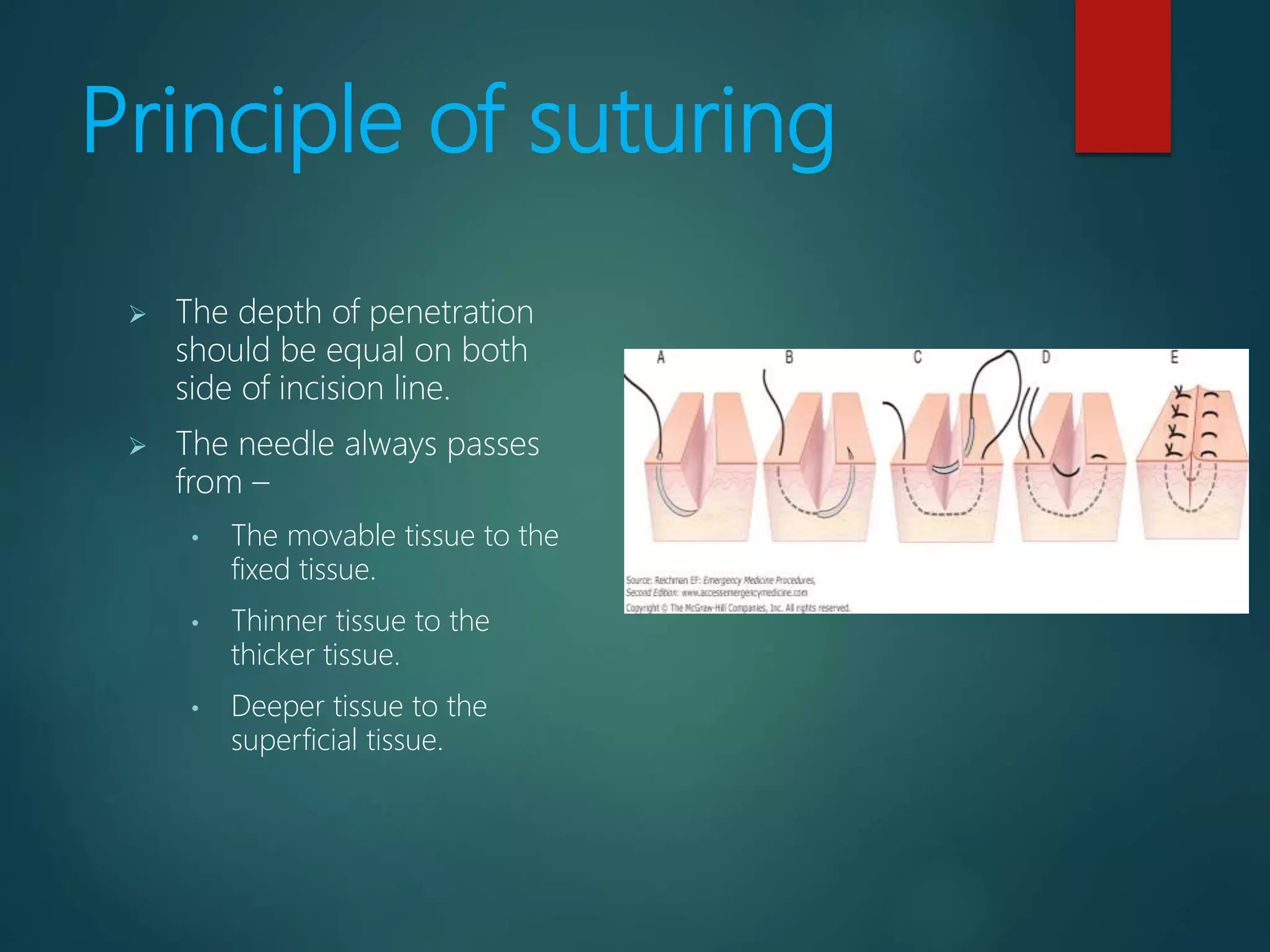 Suture Materials and Suturing Techniques | PPTX