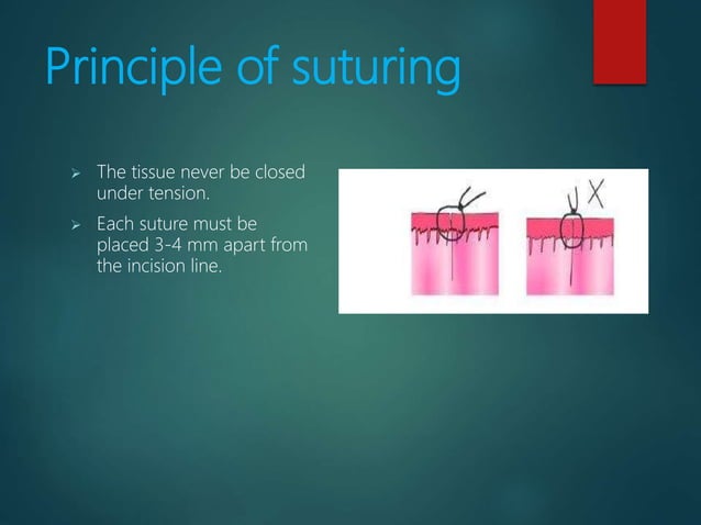 Suture Materials and Suturing Techniques | PPTX | First Aid | Injuries