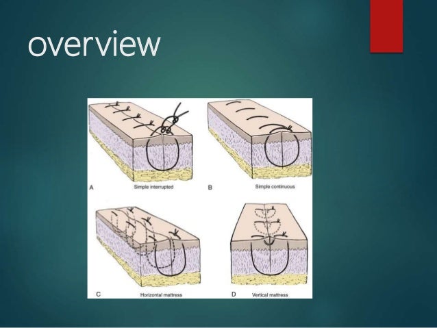 Suture Materials and Suturing Techniques