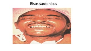 Presentation on Tetanus Disease | PDF