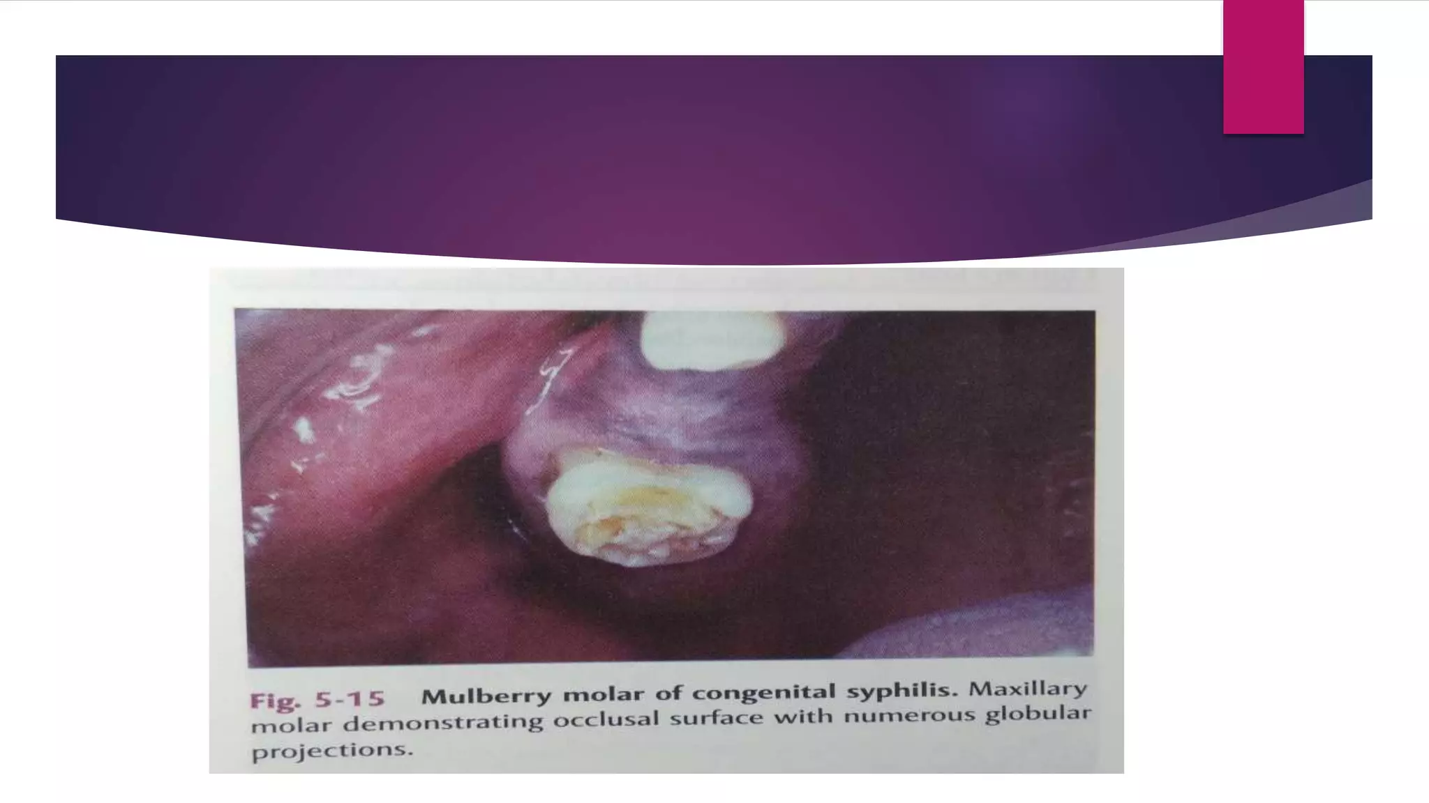 syphilis, gonorrhea and noma | PPT